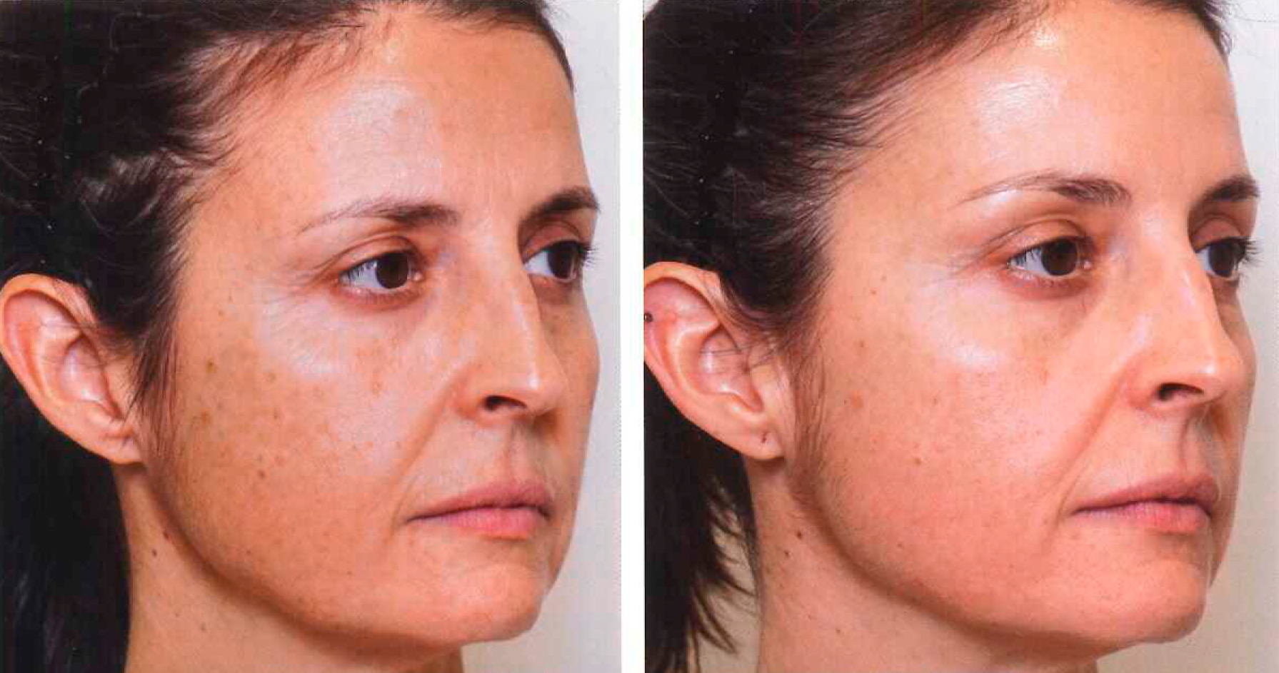 Tratamiento con Exosomas. Rejuvenecimiento facial - Bellísima